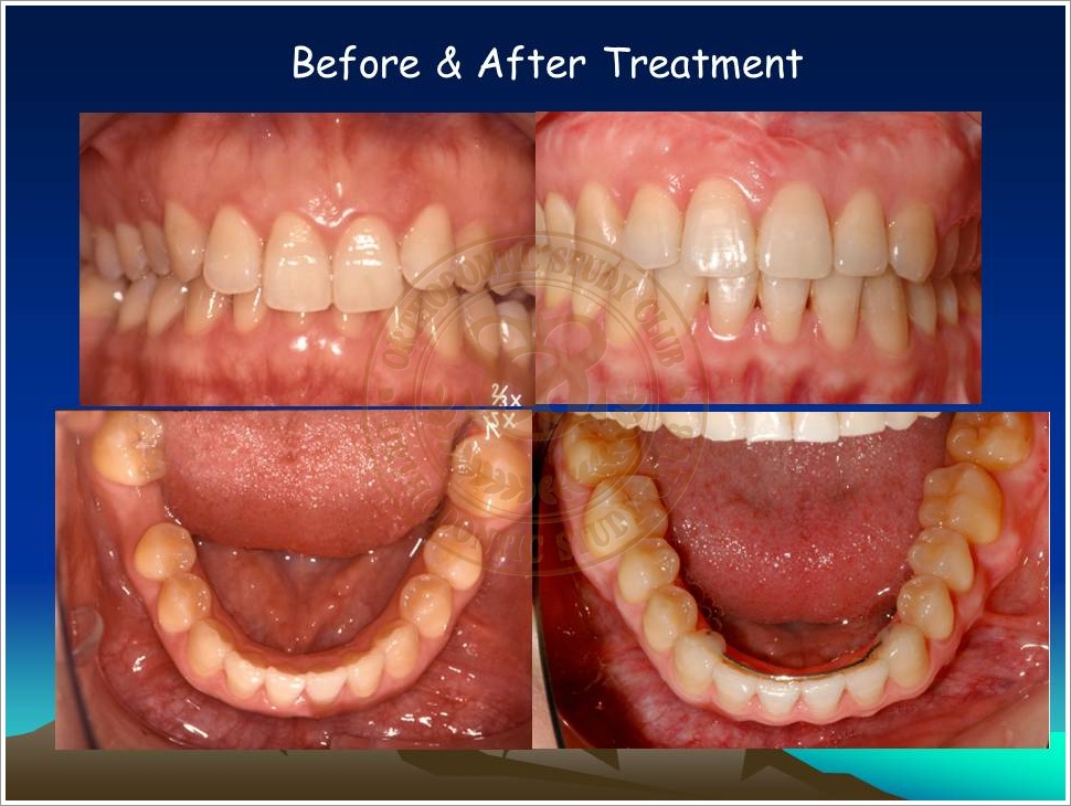 Adult Treatment of Class II, div. 2, Loss of 2 lower molars, TMD ...