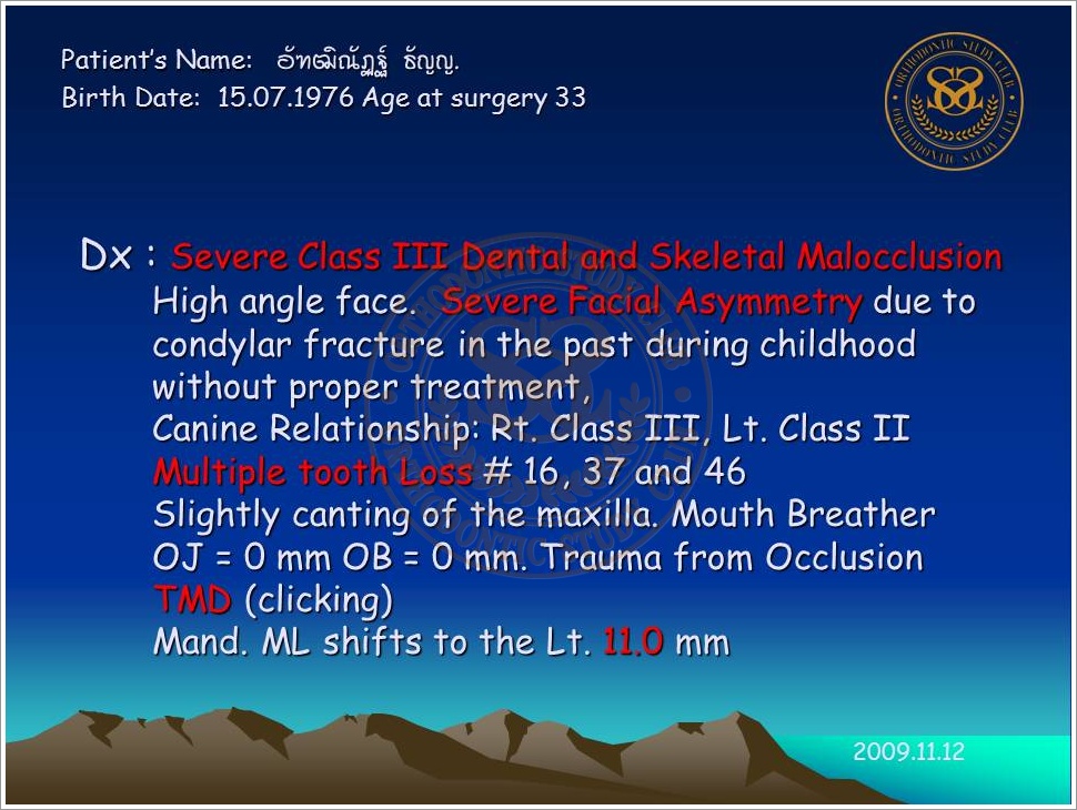 Adult Treatment of severe dental & skeletal Class III malocclusion ...