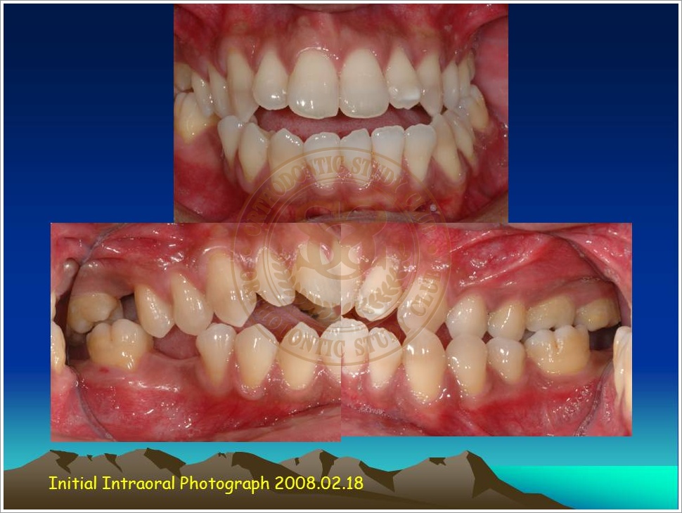 Adult Treatment of severe dental & skeletal Class III malocclusion ...