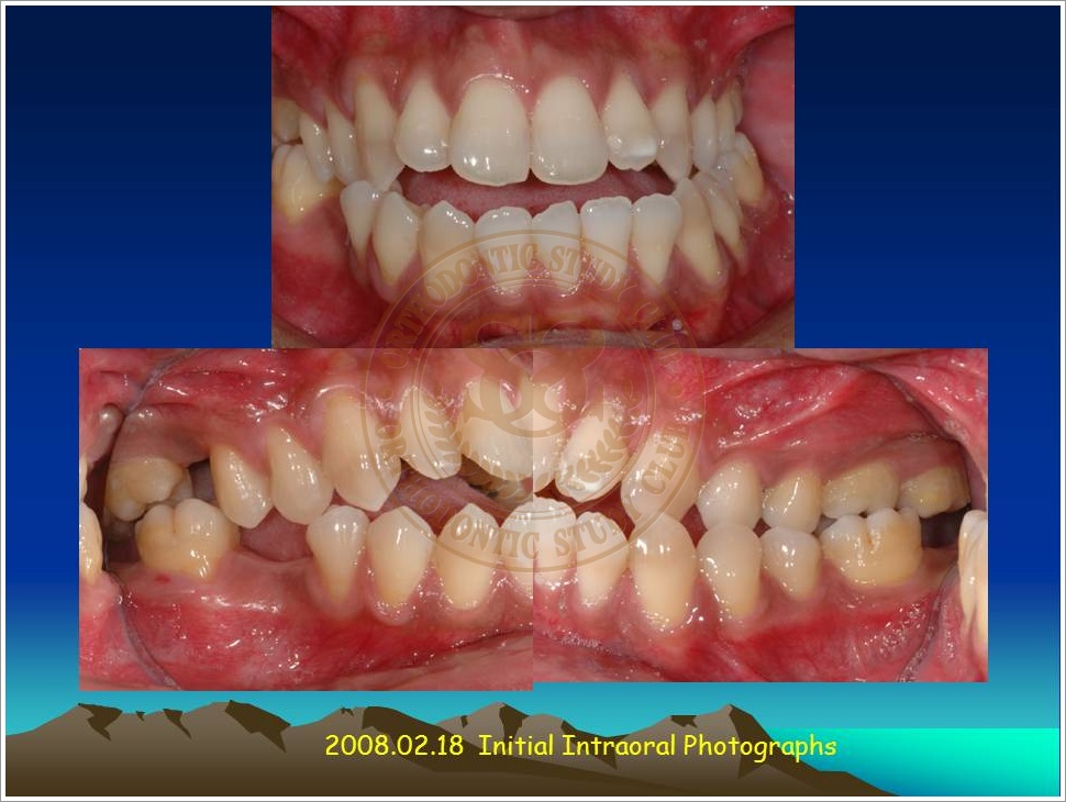 Adult Treatment of severe dental & skeletal Class III malocclusion ...