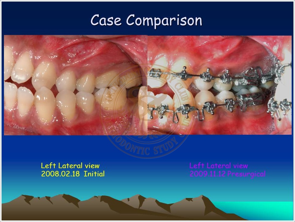 Adult Treatment of severe dental & skeletal Class III malocclusion ...