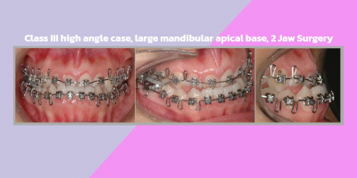 การการรักษา ออโธเปดิกส์ (Jaw Orthopedics)ไม่ใช่ ทันตกรรม – Orthodontic ...