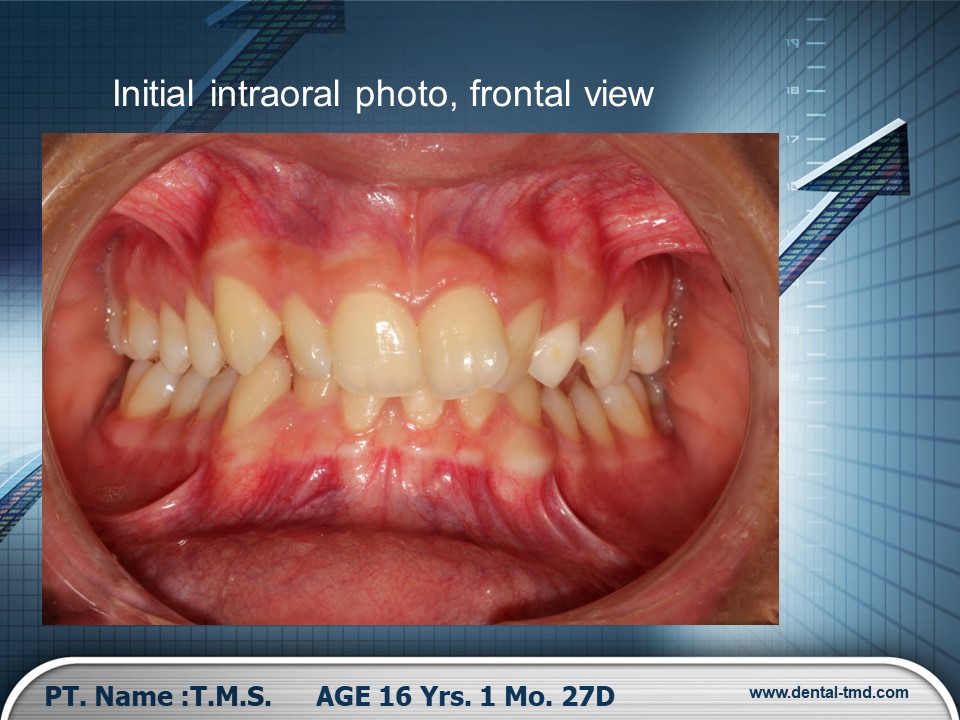 THOMAS, MAYA STELLA CLASS II - Orthodontic and TMD Center