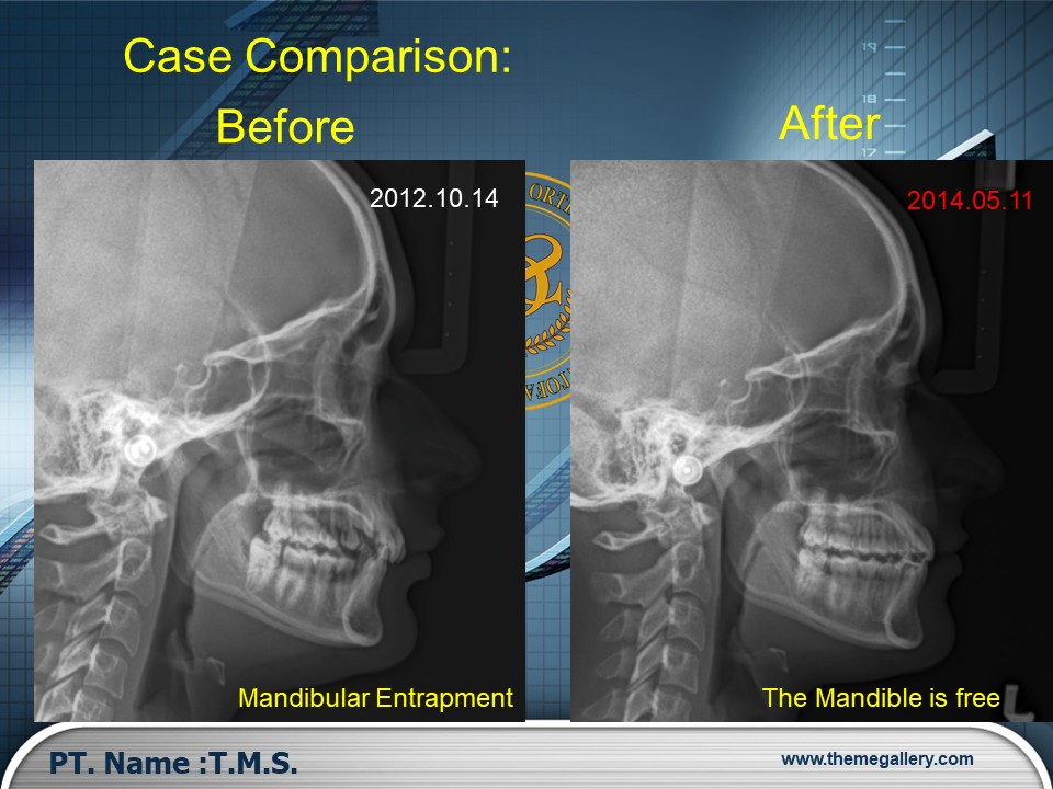 THOMAS, MAYA STELLA CLASS II - Orthodontic and TMD Center