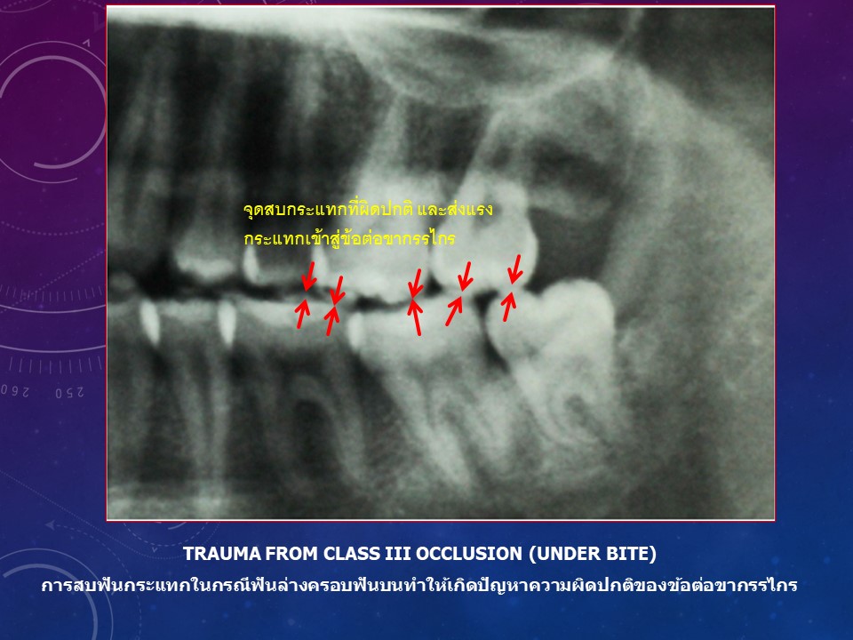 Trauma from Class III Occlusion (Under bite) - Orthodontic and TMD Center